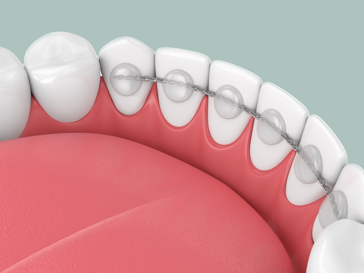 Retainers in Evansville, IN | Cook Orthodontics