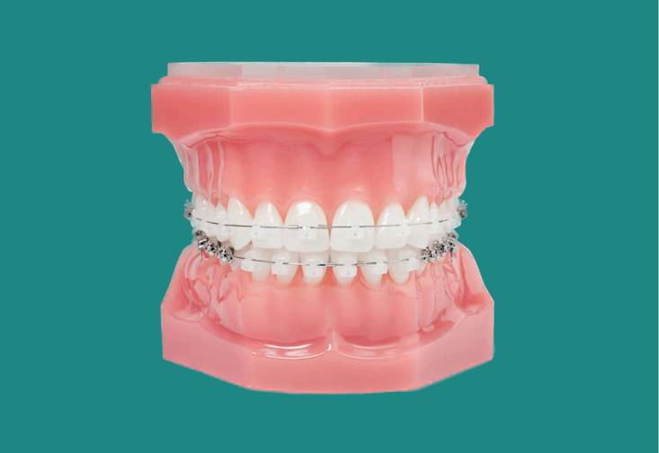 EMPOWER™ Braces in Evansville, IN | Cook Orthodontics