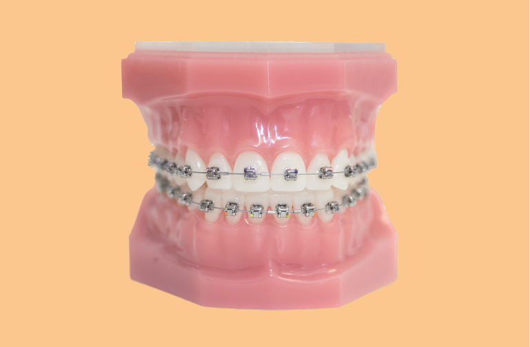 EMPOWER™ Braces in Evansville, IN | Cook Orthodontics