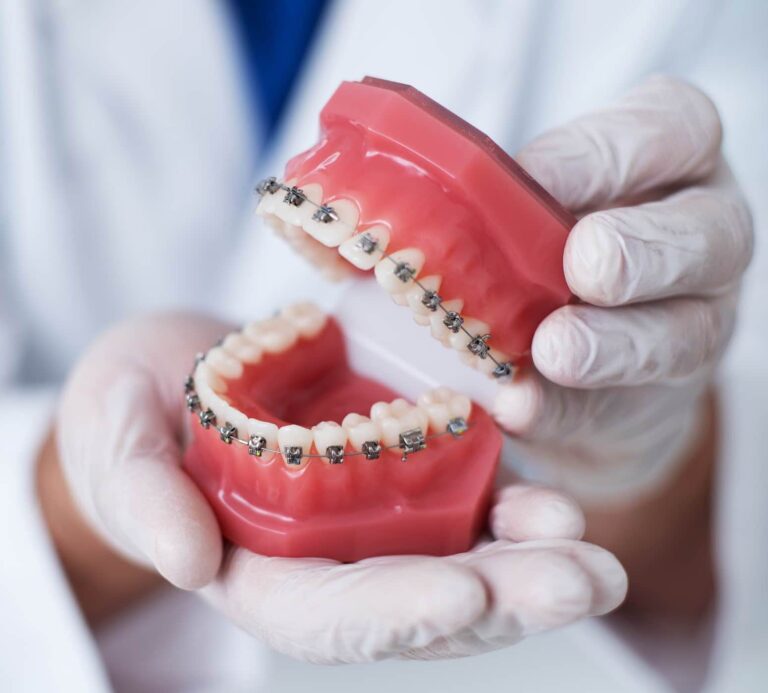 EMPOWER™ Braces in Evansville, IN | Cook Orthodontics